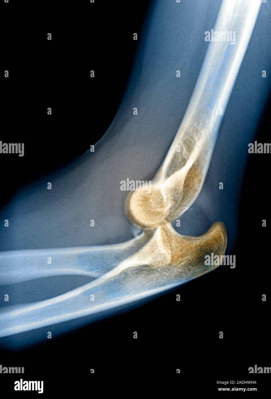 Dislocated elbow. Coloured lateral X-ray of an injury to the elbow ...