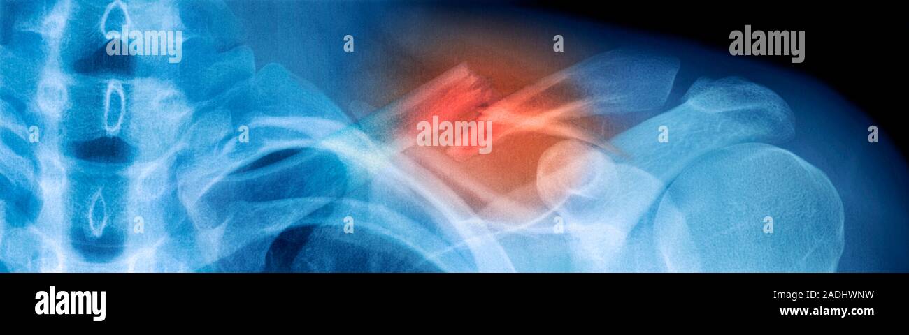 Fractured collar bone. Coloured frontal X-ray of a patient's fractured ...