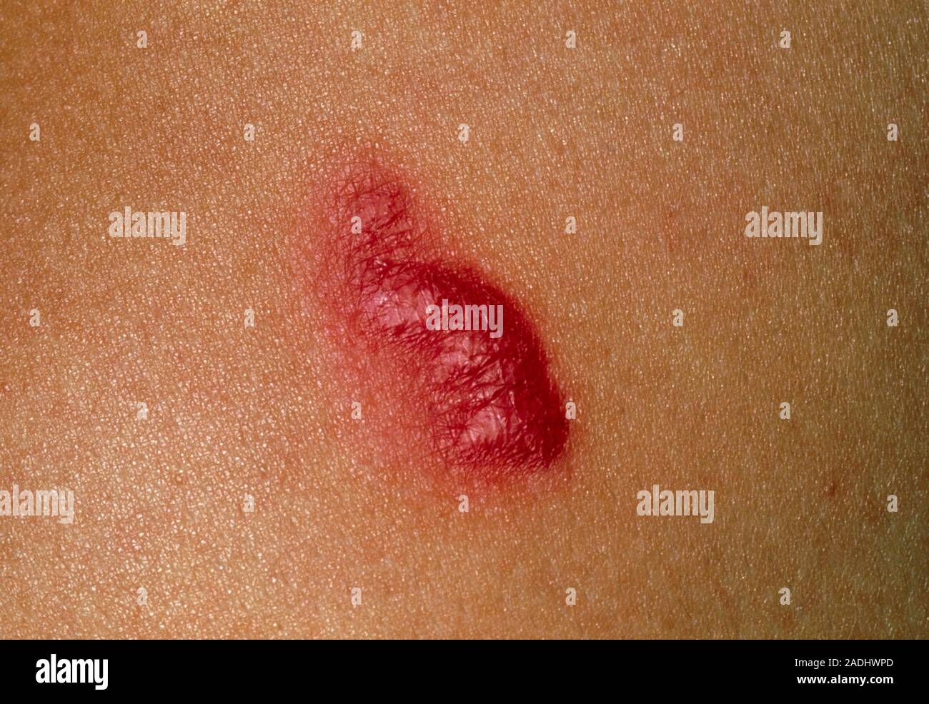 Keloid scar. Close-up of a red keloid scar seen on the skin of a 19 ...