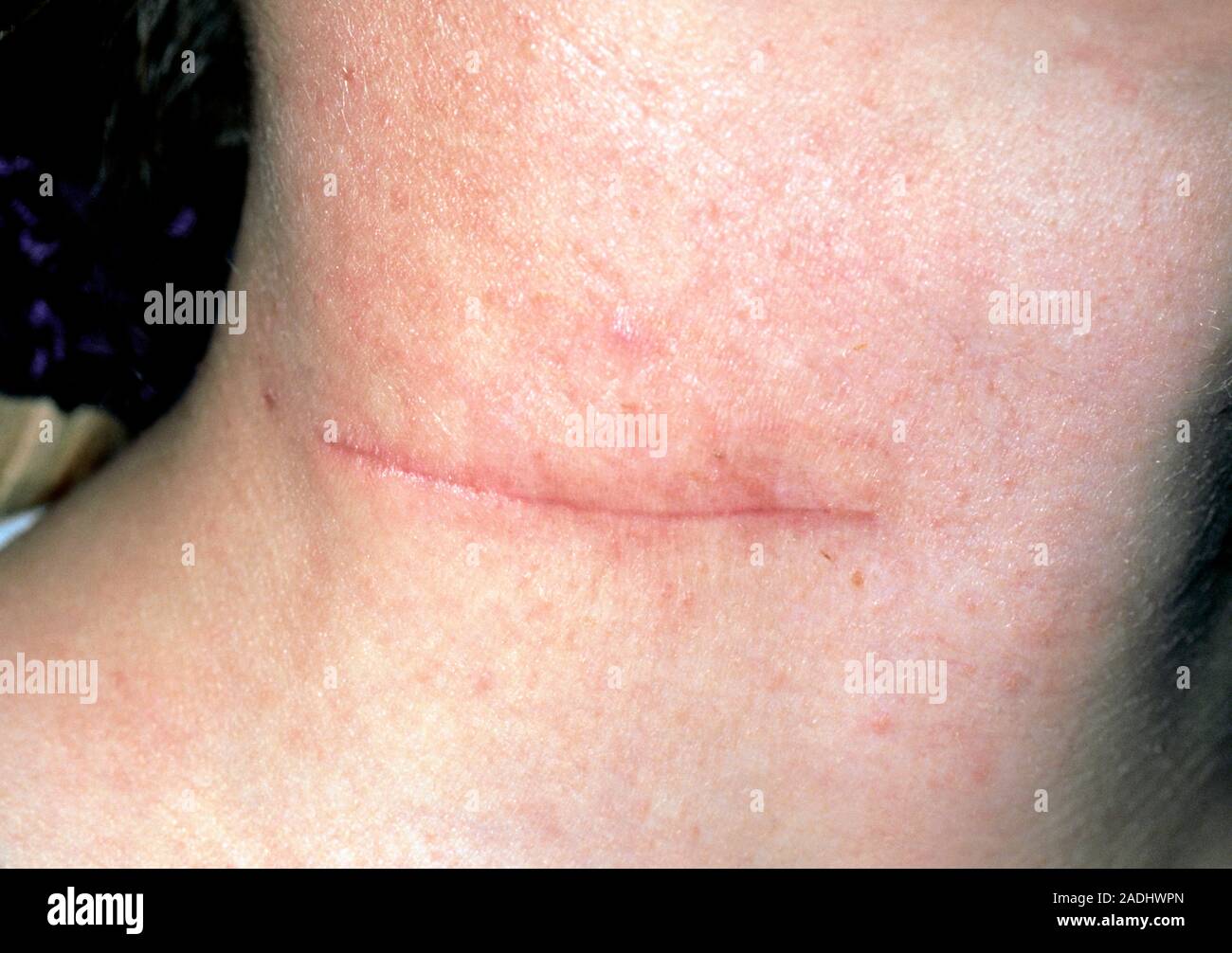 Neck scar. Close-up of a scar on the neck of a 30- year-old woman, 3 ...