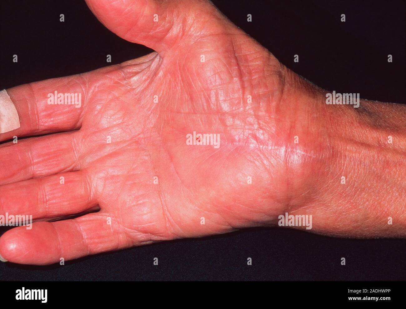 Surgical scar. Wrist and hand of a 79 year old man showing a scar from ...