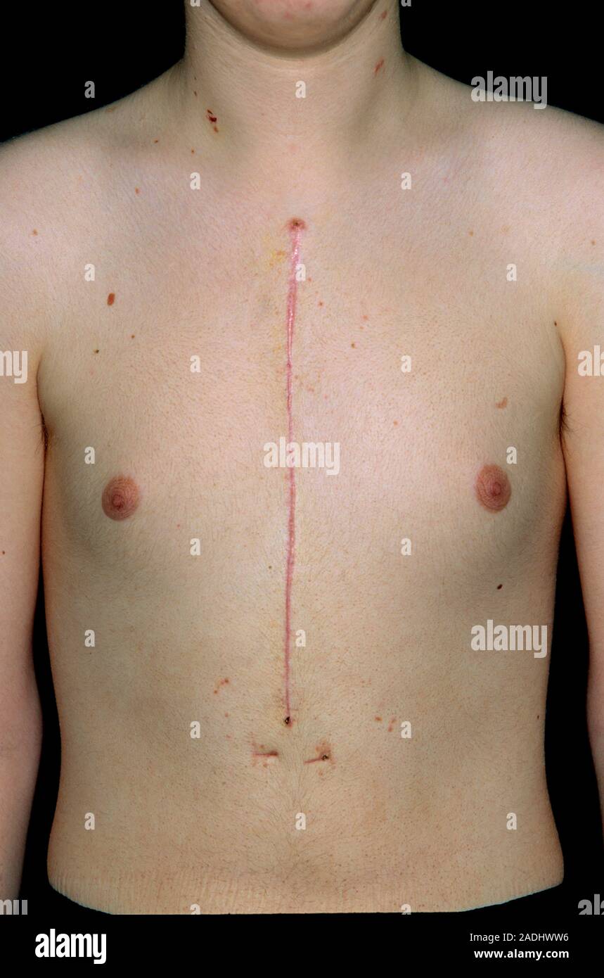 Scar on the chest of a 17 year old boy one month after a heart ...