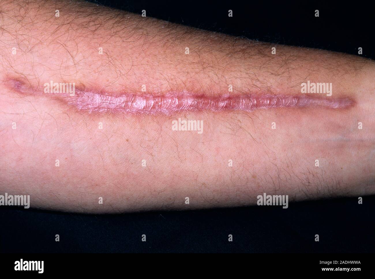 Keloid scar on the forearm of a 57-year-old male patient following an ...