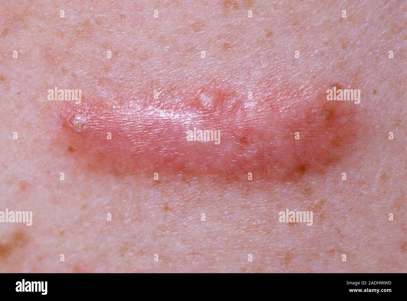 Keloid scar on the chest wall of a 29-year-old women. A keloid is a ...