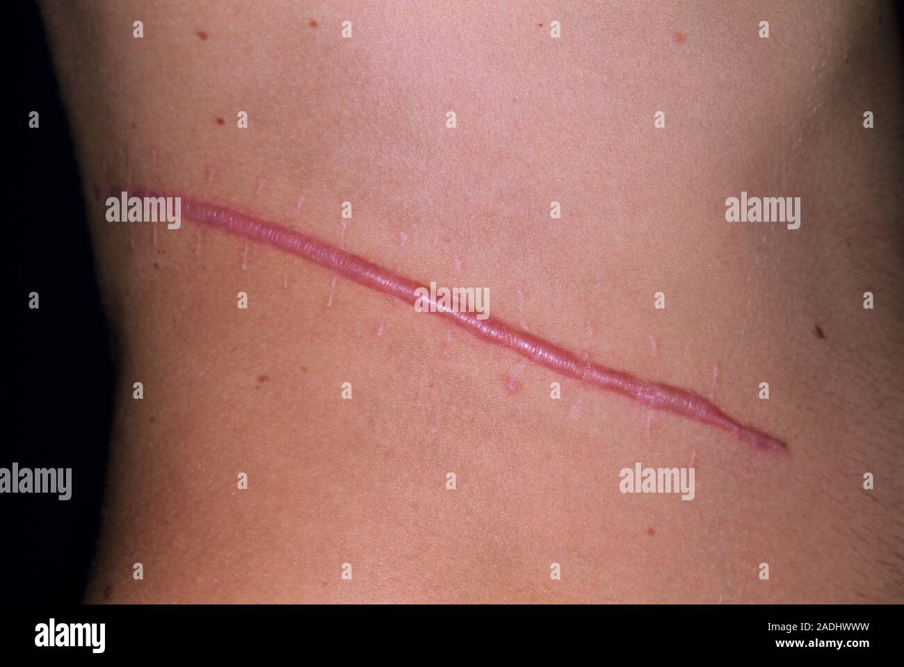 Keloid scar on the torso of a 25-year-old man. The patient had been ...