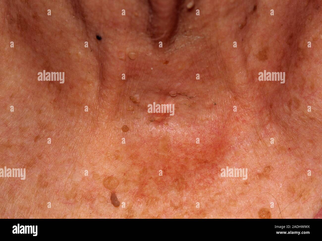 Tracheostomy scar on the neck of a 91-year-old man. A tracheostomy ...