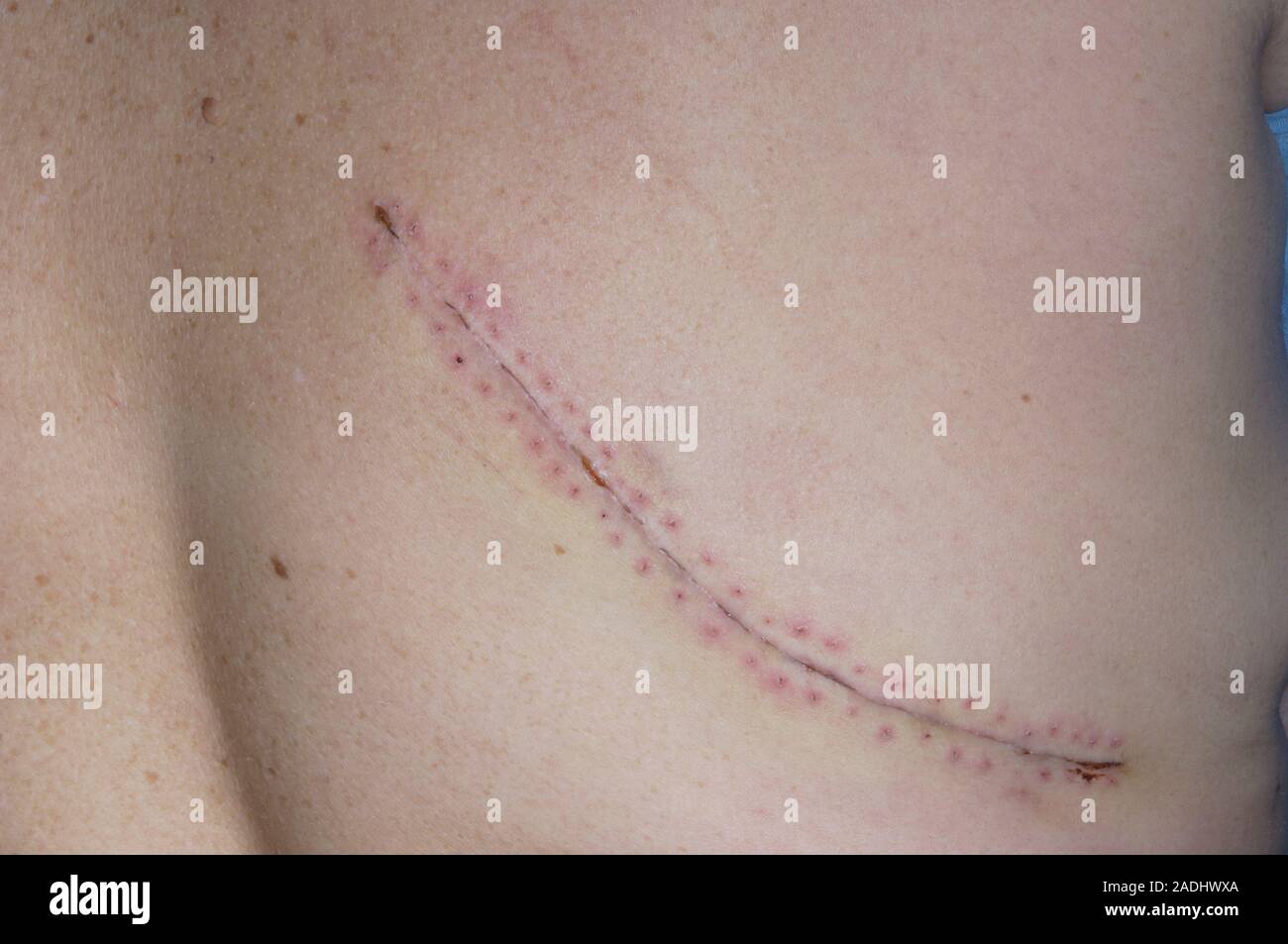 Scar on the back of a 42 year old man following surgery to repair a ...