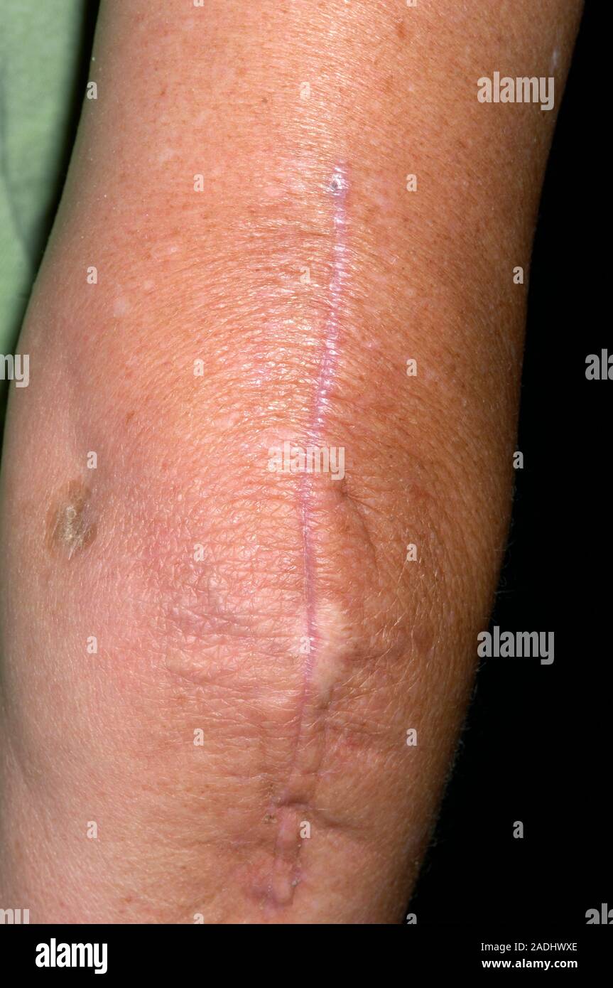 Elbow replacement scar. Scar on a 65 year old woman's elbow 6 weeks ...