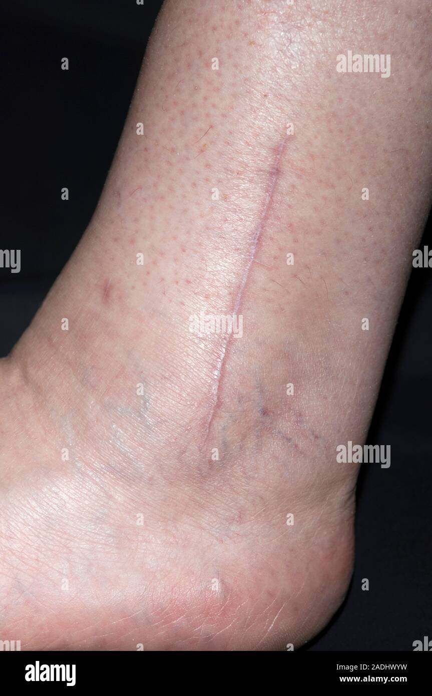 MODEL RELEASED. Scar on a fractured ankle. Ankle of a 62 year old woman ...