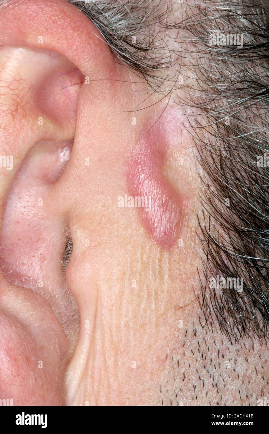 Keloid scar in front of the ear of a 37 year old man. A keloid scar is ...