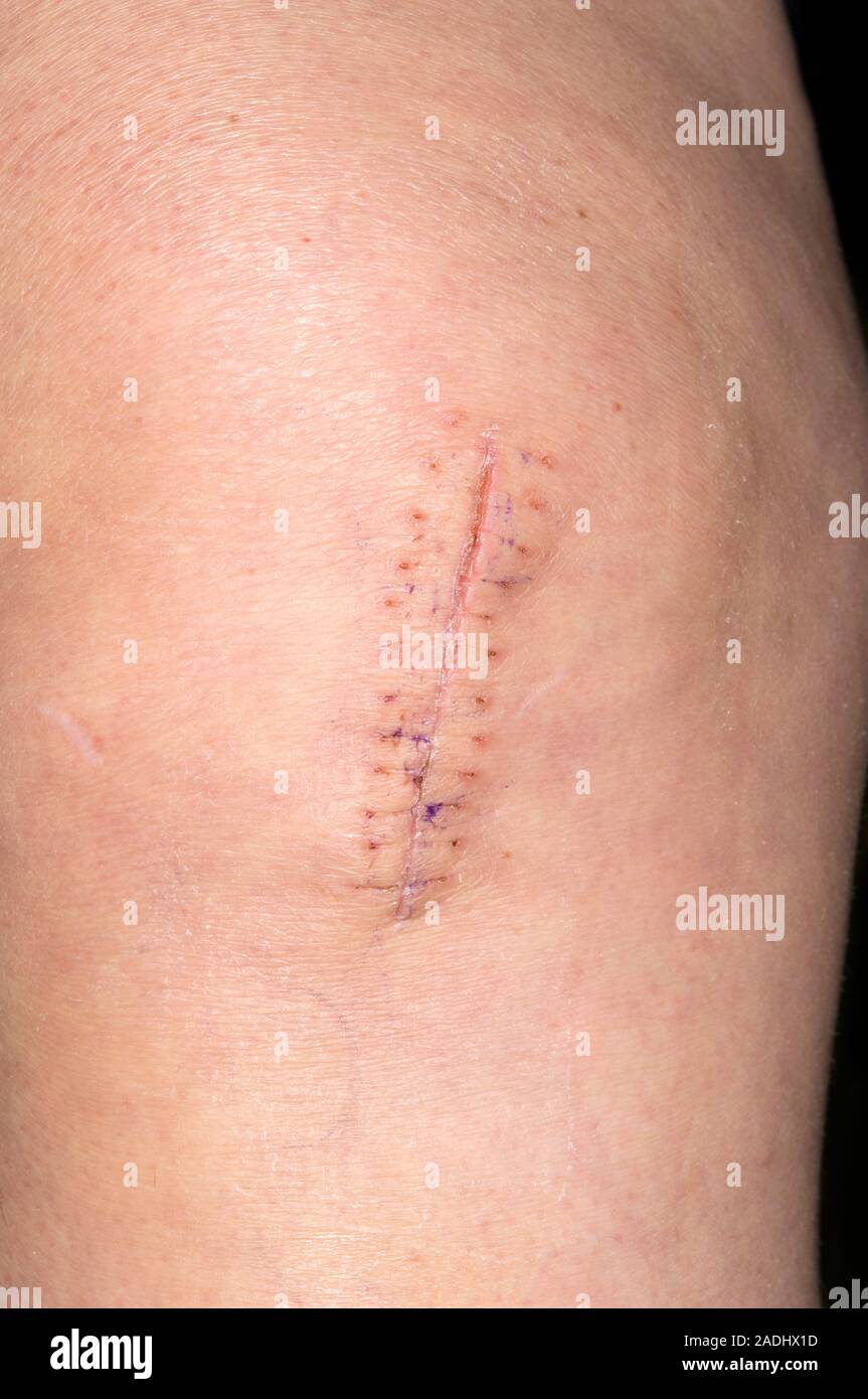 Knee surgery scar. 2-week-old scar on the knee of a 58 year old woman. This is from a partial ...