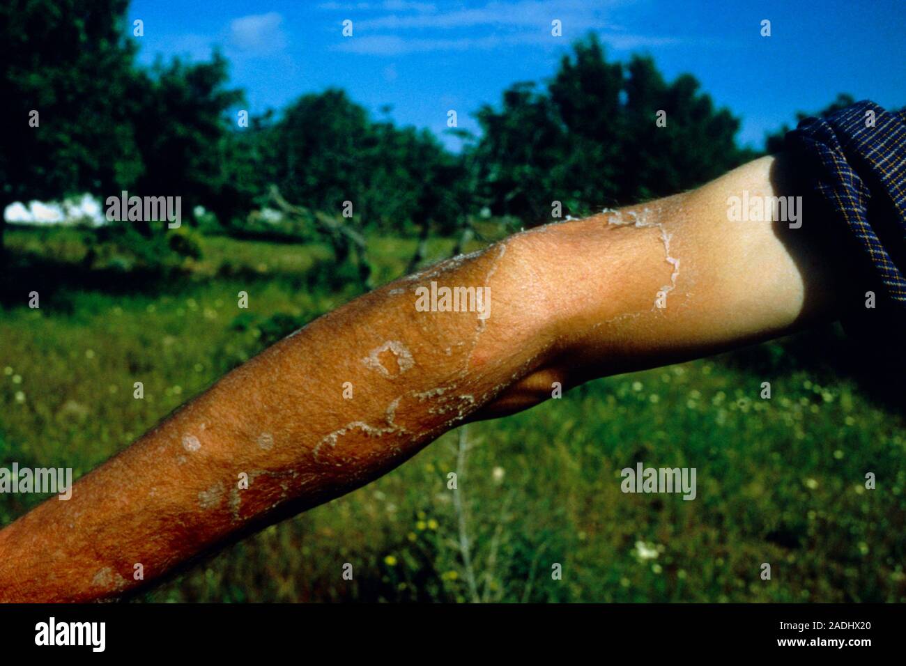 Effects of sunburn on a man's arm, showing peeling outer layer of skin ...