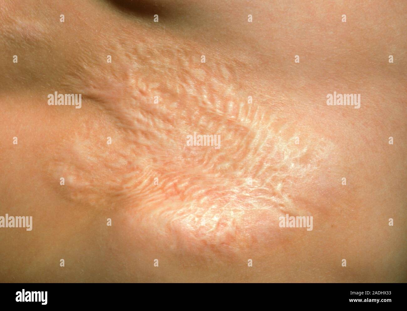 Burn scar. Scar seen on the skin of a child caused by scalding. A scald ...