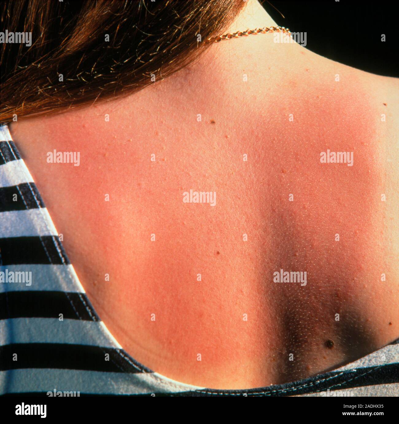 Sunburn. A red patch of skin seen on the back and shoulders of a woman ...