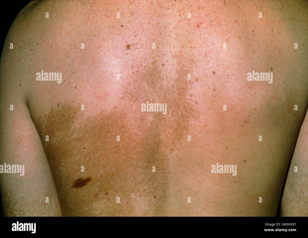 Pigmentation by sunburn. View of dark patches of skin on the back of a ...