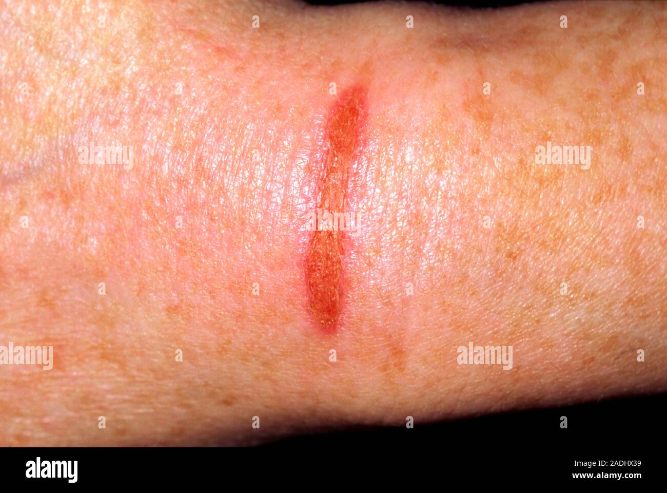Kitchen burn. Close-up of a burn on the forearm of a 43-year-old woman ...