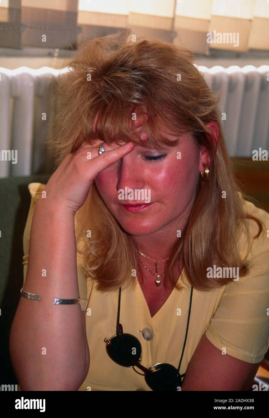 Sunburn. View of a sunburnt woman holding her head suffering from a ...