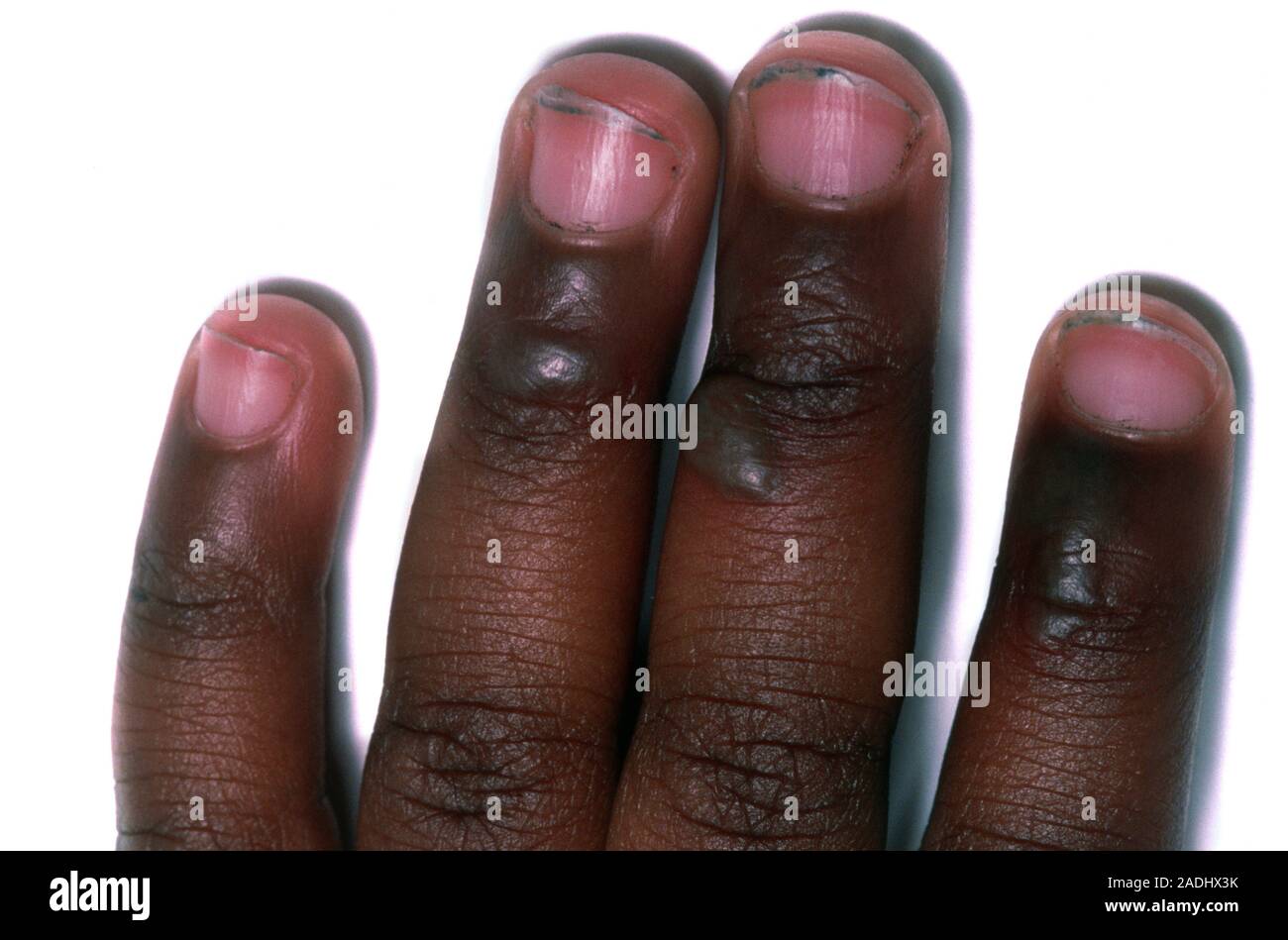 Second degree burns. Close-up of fingers blistered by second degree ...