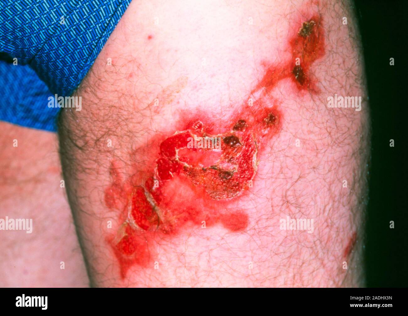 Boiling water burn. View of the leg of a 58 year old man showing ...
