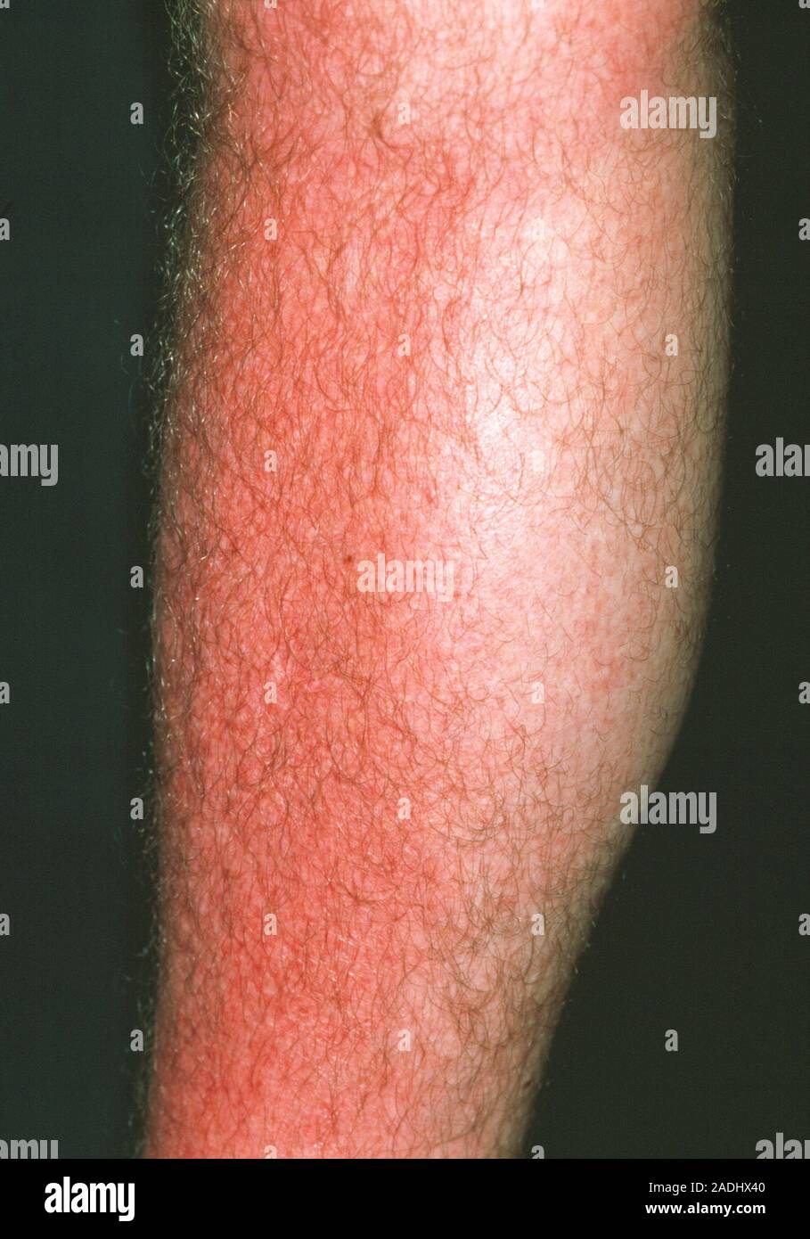 Sunburn on the skin of a 44-year-old man's shin. Sunburn results from ...
