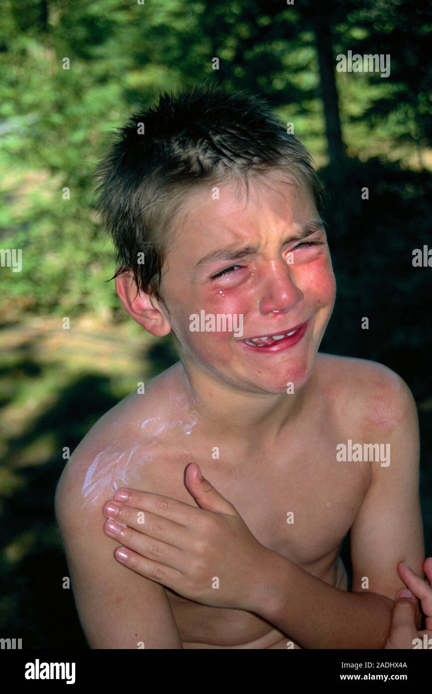 Sunburn. Crying boy applying a soothing cream to his sunburnt shoulder ...