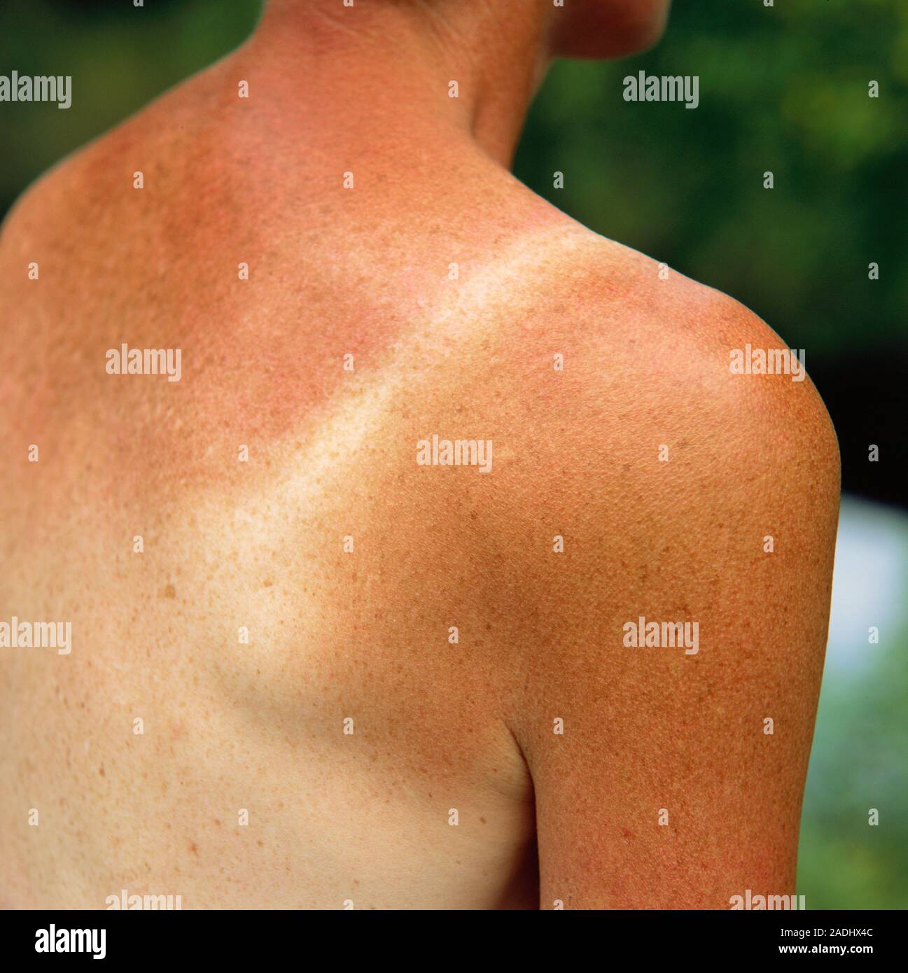 Sunburnt skin. Back, shoulder and neck of a woman whose skin has ...