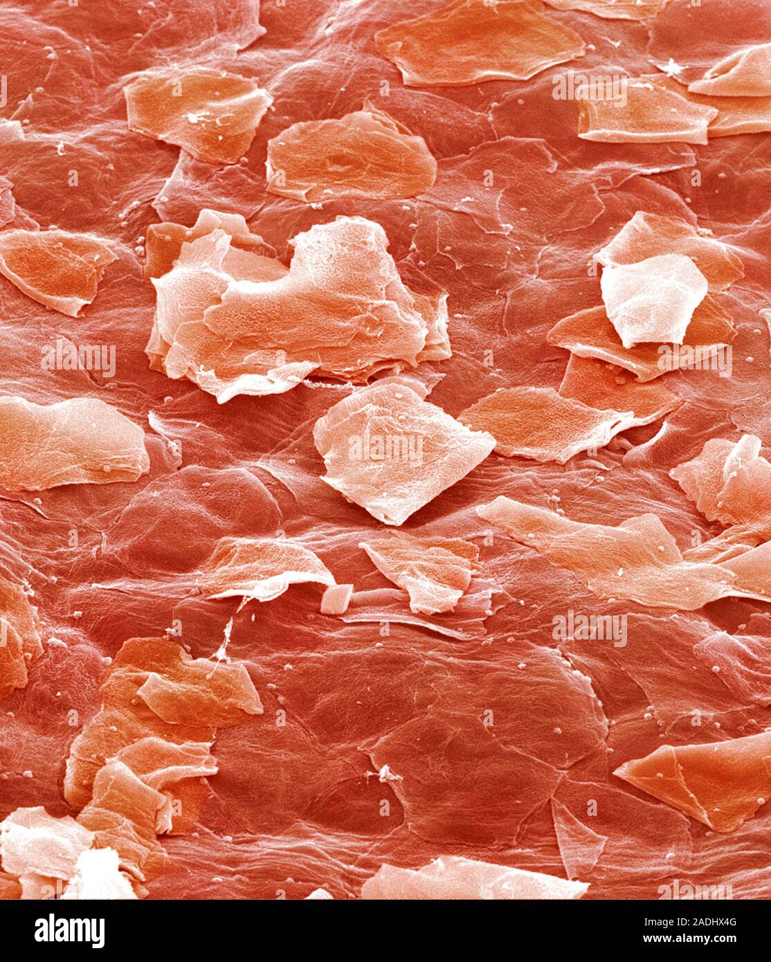 Sunburnt skin. Coloured electron micrograph (SEM) of epidermal skin ...