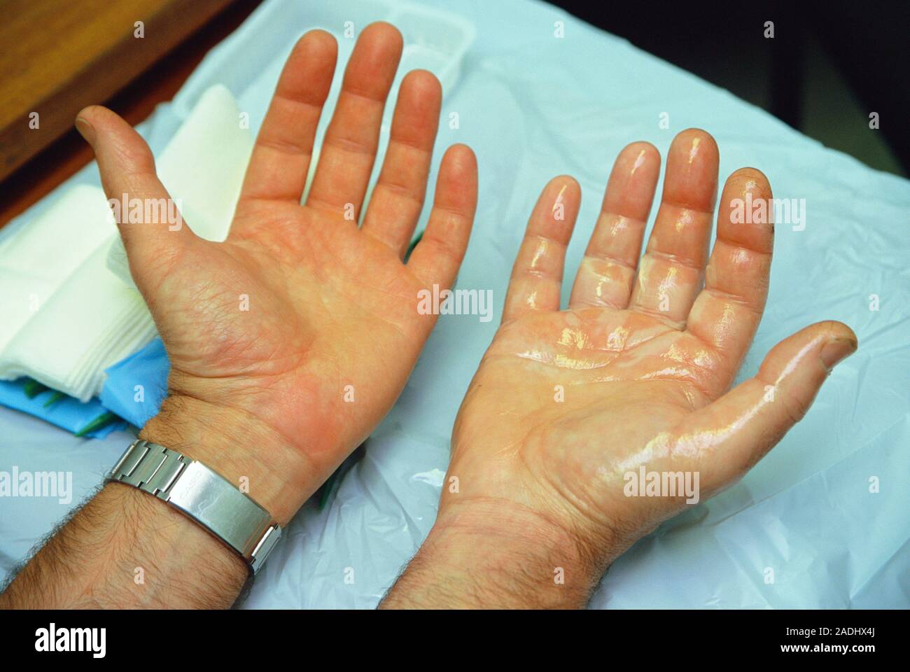 Burns Treatment Image 1 Of 4 Superficial Burns To A Mans Right Hand