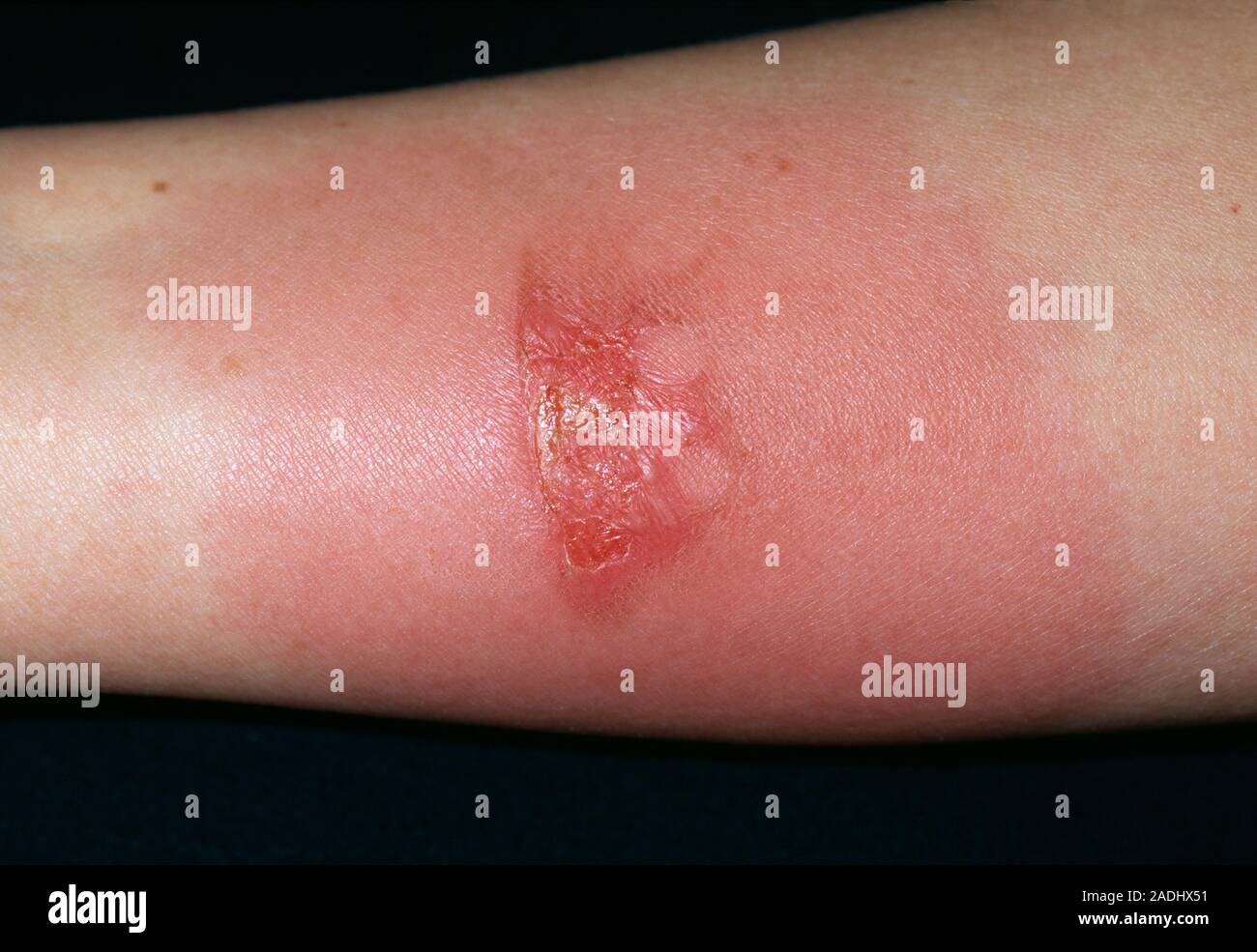 Infected burn on a 40-year-old woman's arm. This is one week after ...