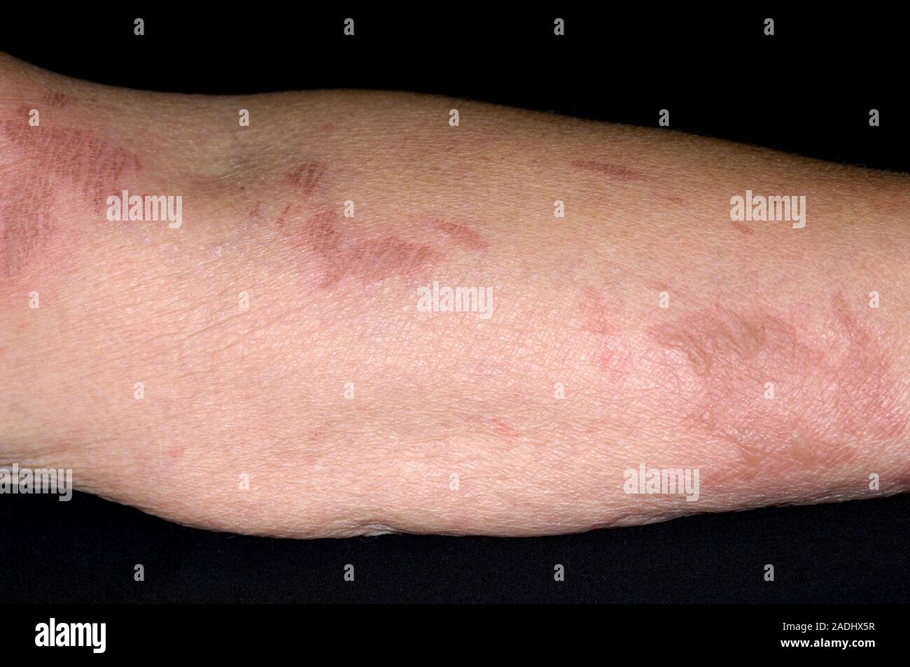 Cooking oil burns. Burns on a 74 year old woman's arm 1 day after an ...