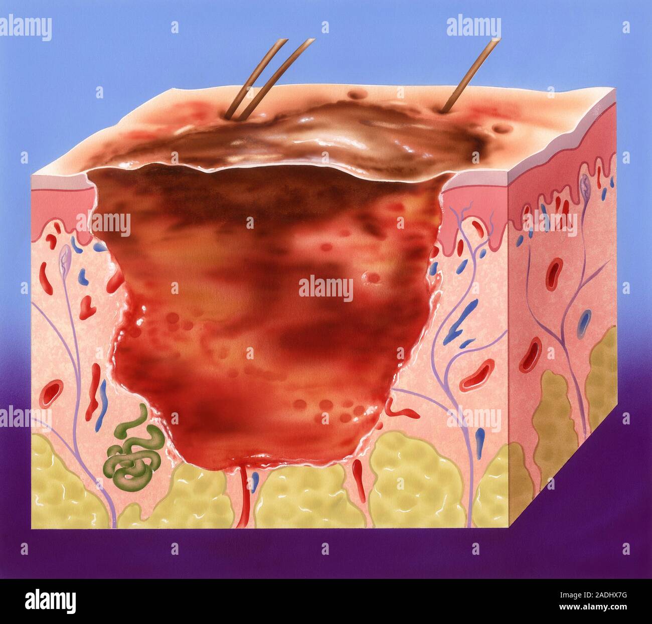 Third-degree burn, cut-away artwork. A third-degree burn is a severe ...