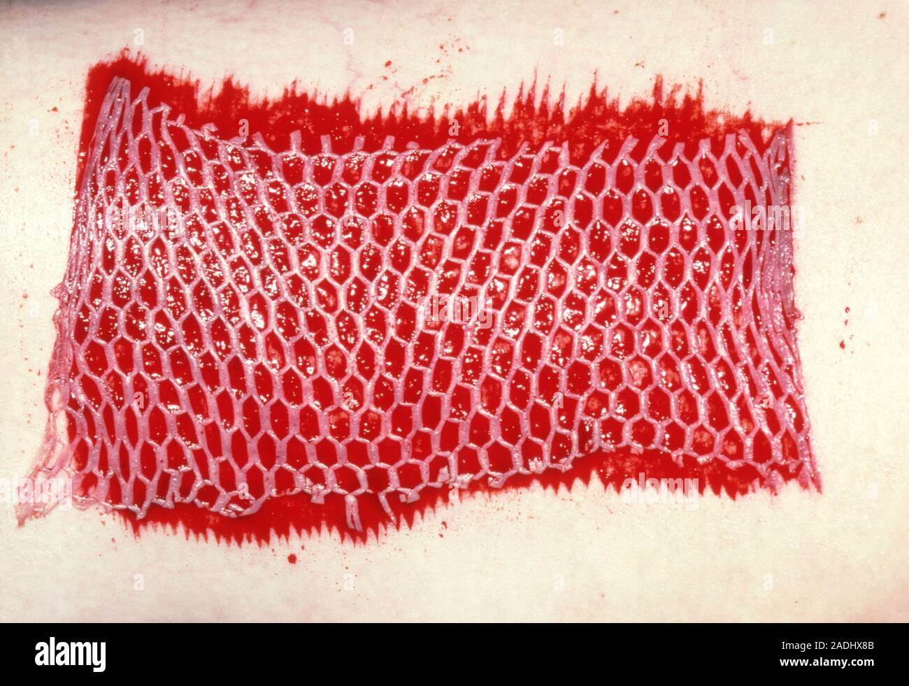 Mesh skin graft attached to full thickness burn injury. A piece of skin ...
