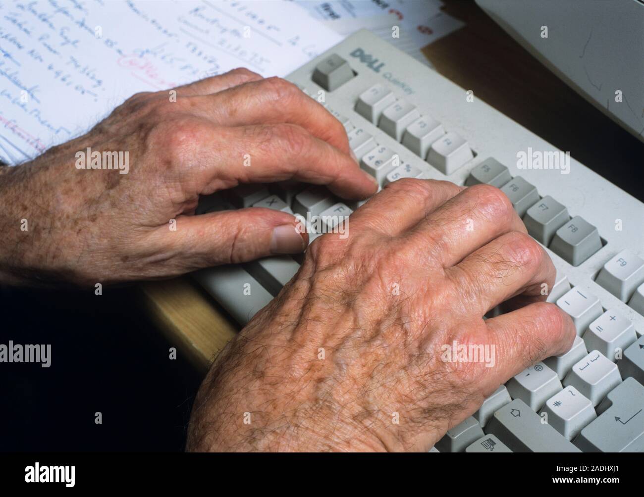 Elderly person typing on a computer keyboard. They have inflamed joints ...
