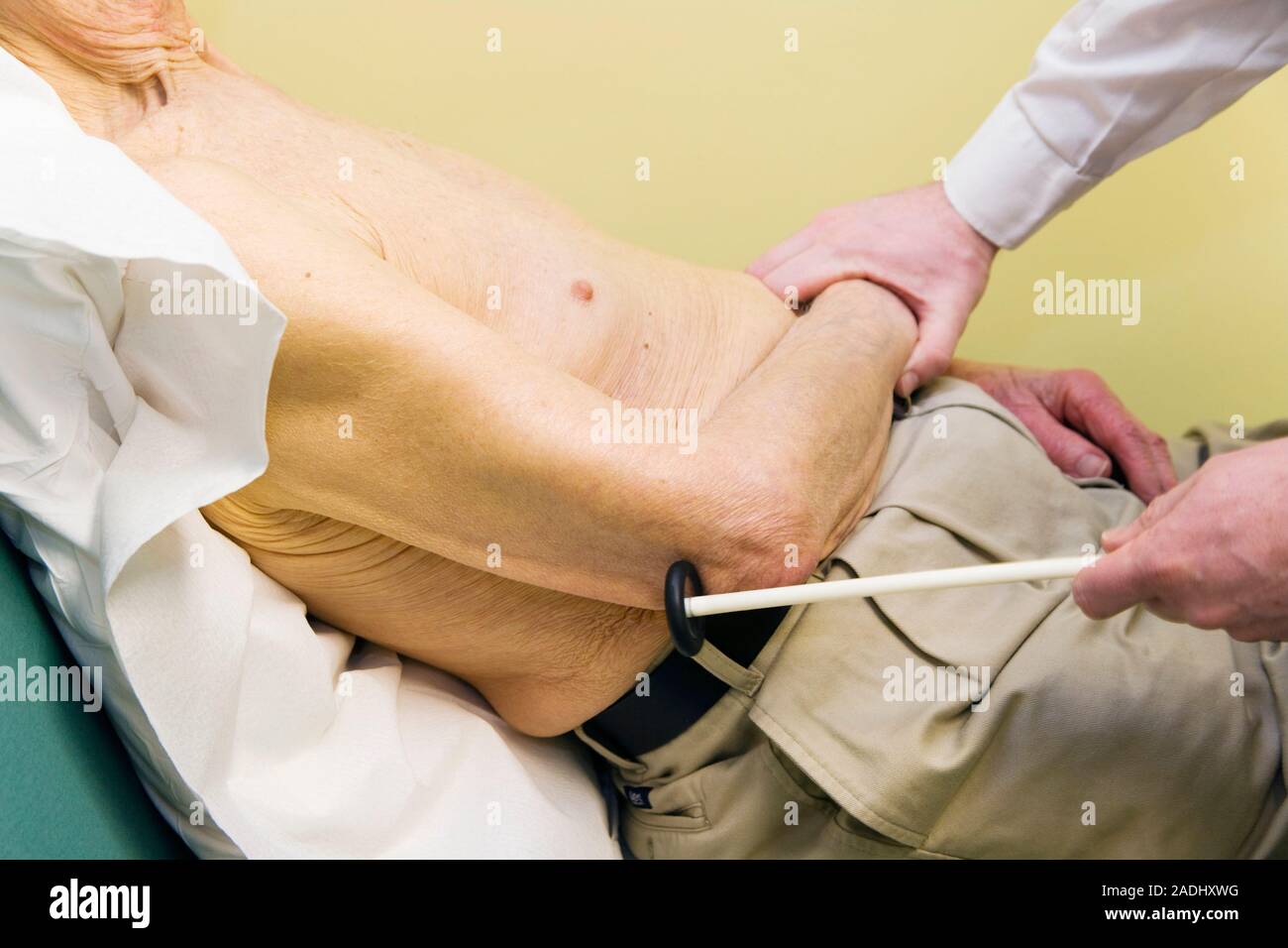 Elbow reflex test. Doctor performing a reflex test with a hammer on a ...
