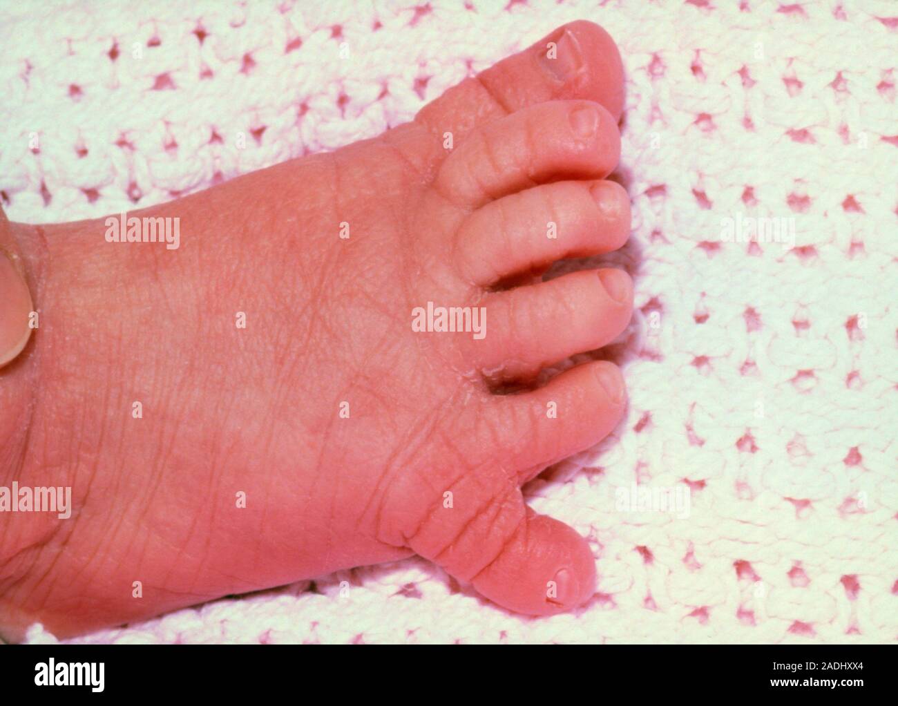 Infant with six toes(supernumary). The additional toe protrudes at an ...