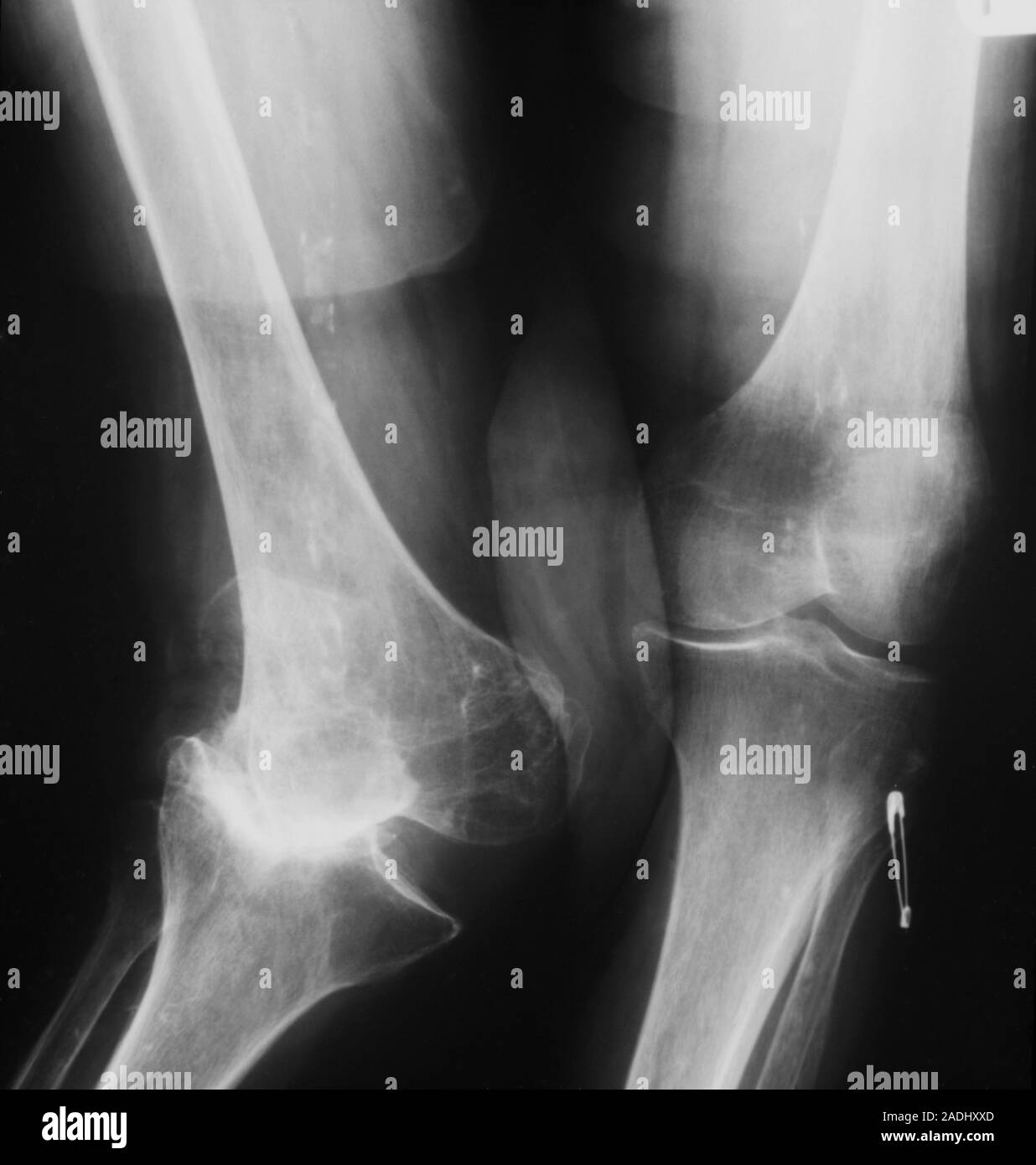 X-ray showing a congenital deformity of the right knee in which the ...
