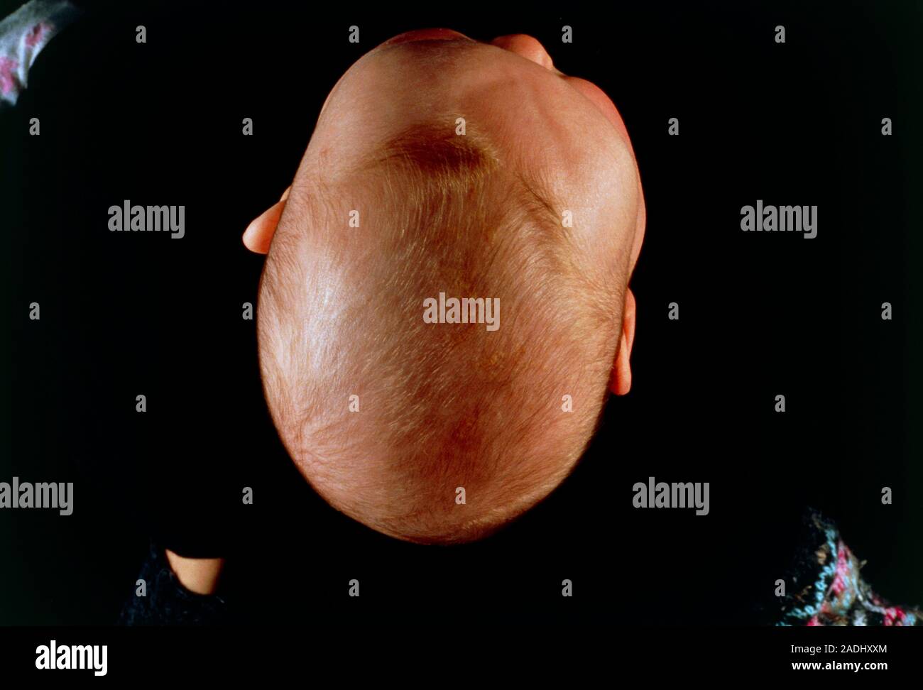 Superior view of a baby's head showing sign of plagiocephaly. This is a ...