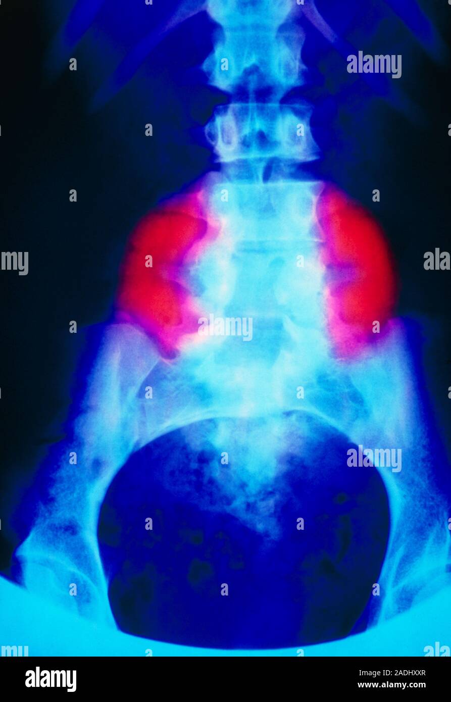 False-colour X-ray showing a large meningo- myelocele in a spina bifida ...