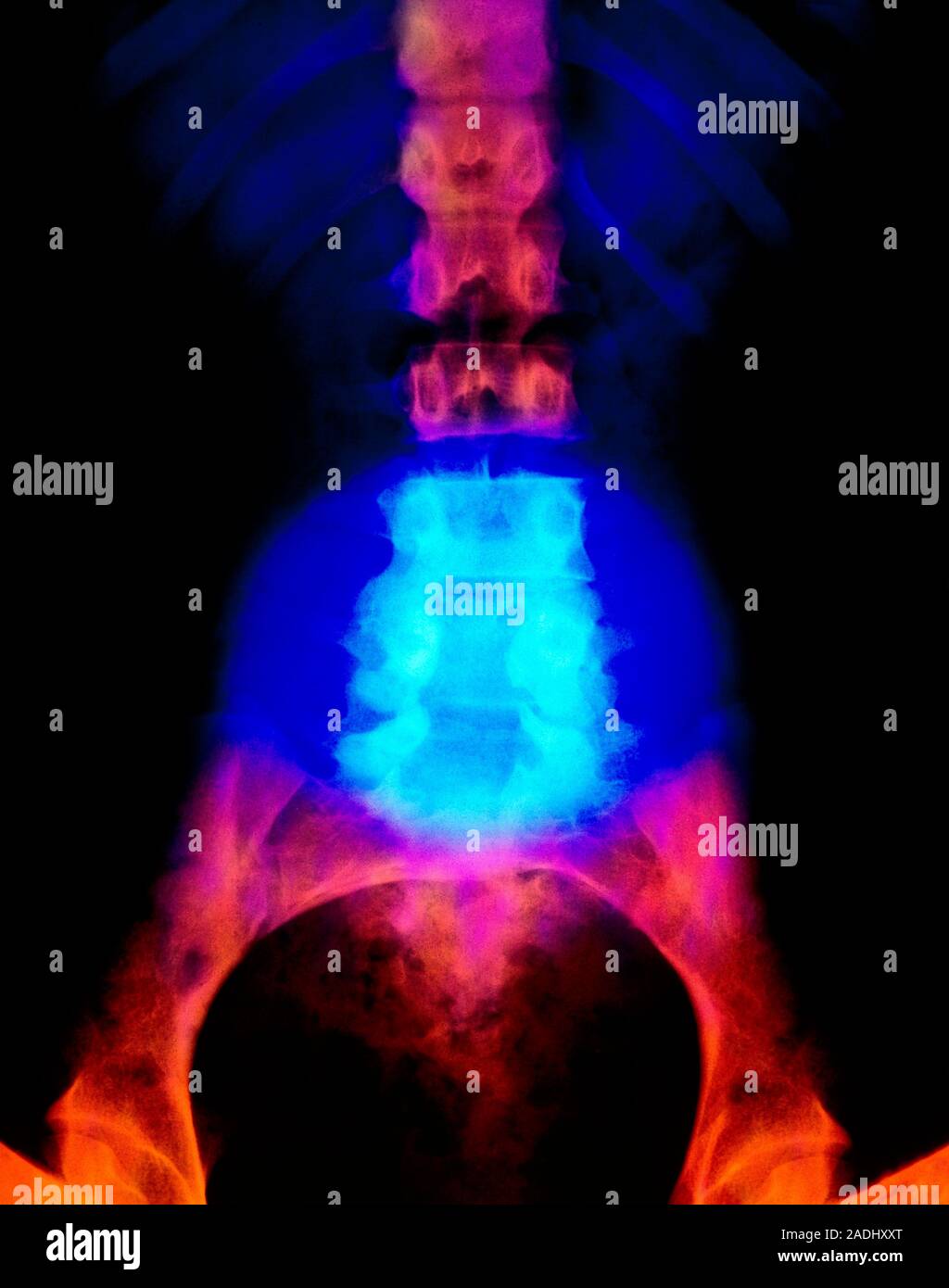 False-colour X-ray showing a large meningo- myelocele in a spina bifida ...