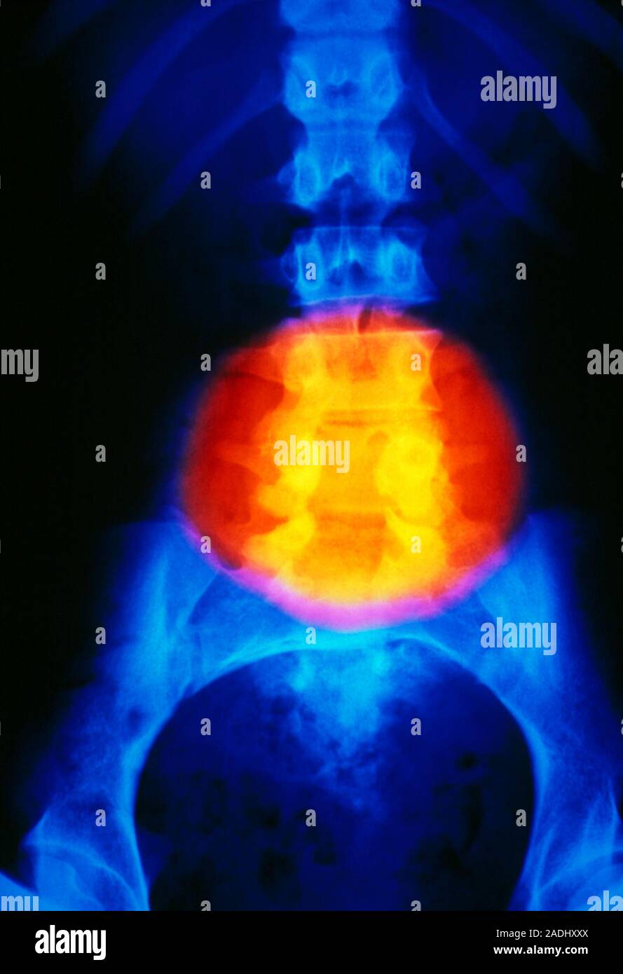 False-colour X-ray showing a large meningo- myelocele in a spina bifida ...