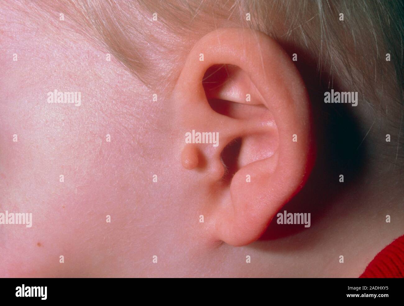 Auricular appendage of the ear. This small swelling immediately in ...