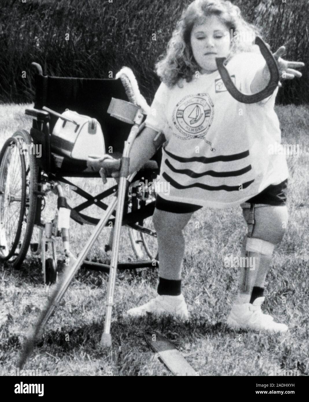 Spina bifida. Young woman with spina bifida throws a horseshoe during a ...