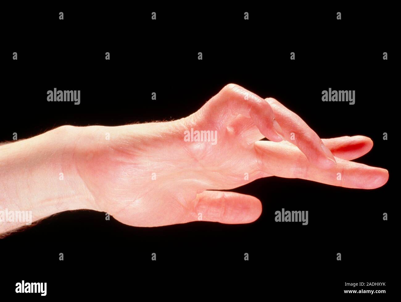 Claw-hand. Contracted fingers (claw-hand) in an adult. This was caused ...
