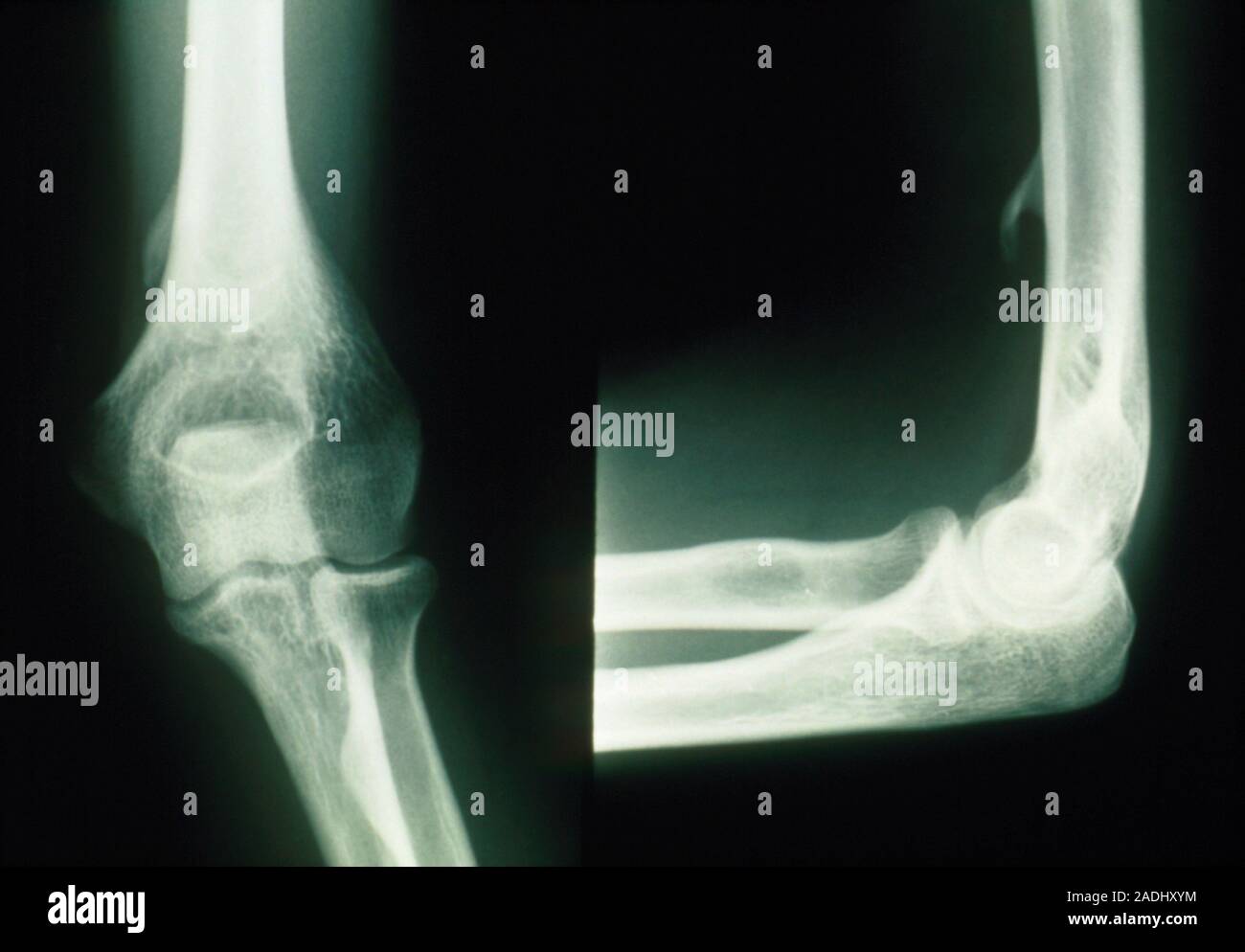 Ligament of Struthers. X-ray photograph of the elbow showing the ...