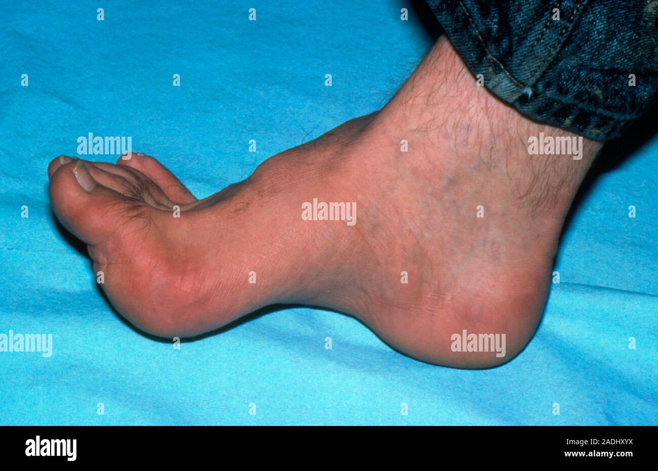 Claw foot. A man's foot with pes cavus (claw foot), showing an ...