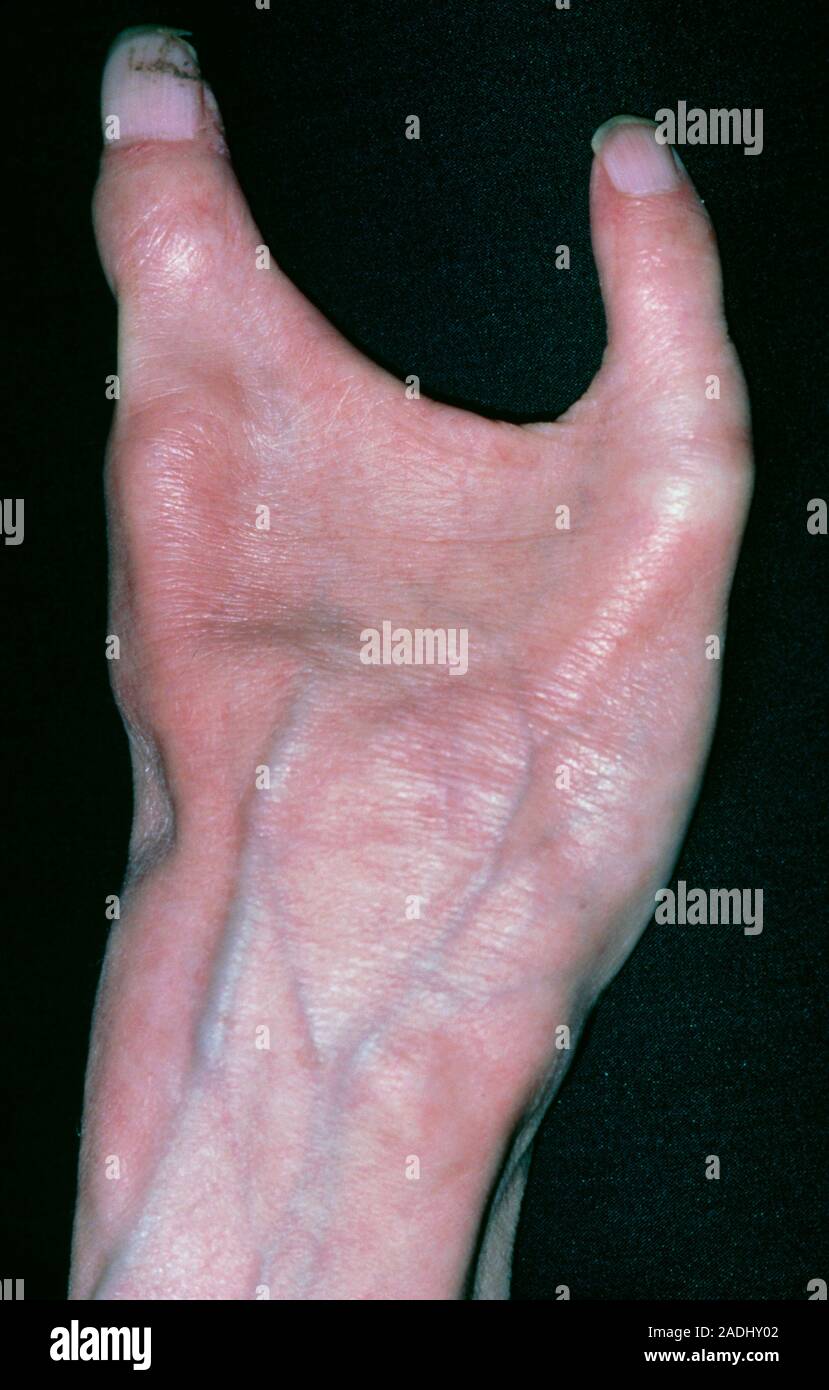 Congenital absence of three fingers. Close-up of a patient's deformed ...