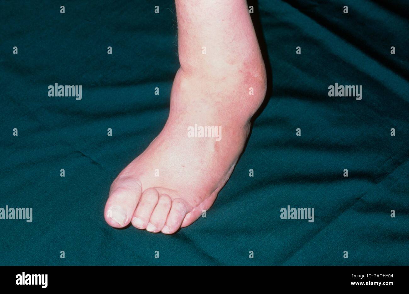 Neuropathic foot. Deformity of a patient's foot and ankle due to ...
