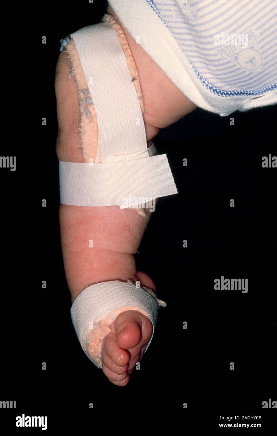 Club foot corrected. Deformed foot of a 1 month old baby boy in a ...