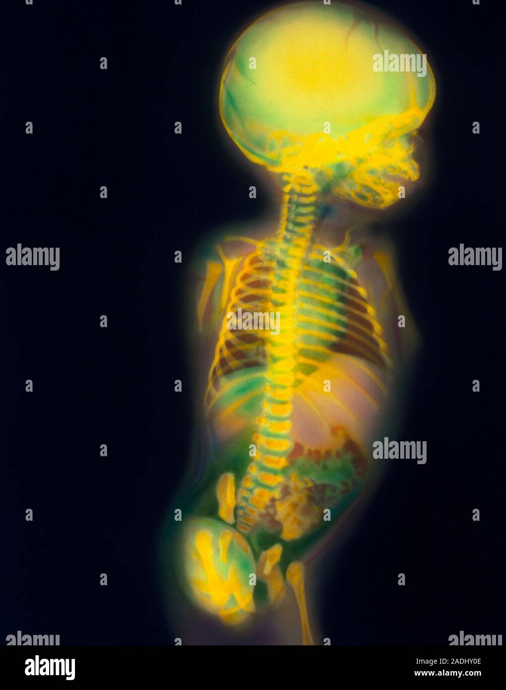 Thalidomide child. Coloured X-ray of the head and body of a child with ...