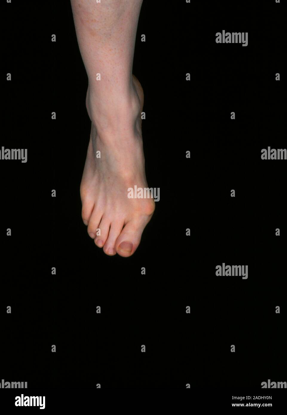 Hallux valgus. Inward-turning toes on a woman's foot. This deformity ...